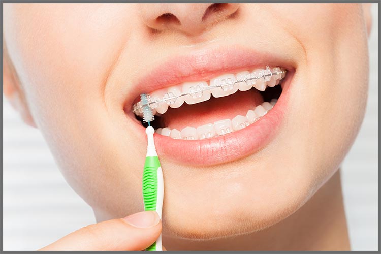 COMPLETE CARE GUIDE FOR YOUR TEETH WITH BRACES | HUNT ORTHODONTICS